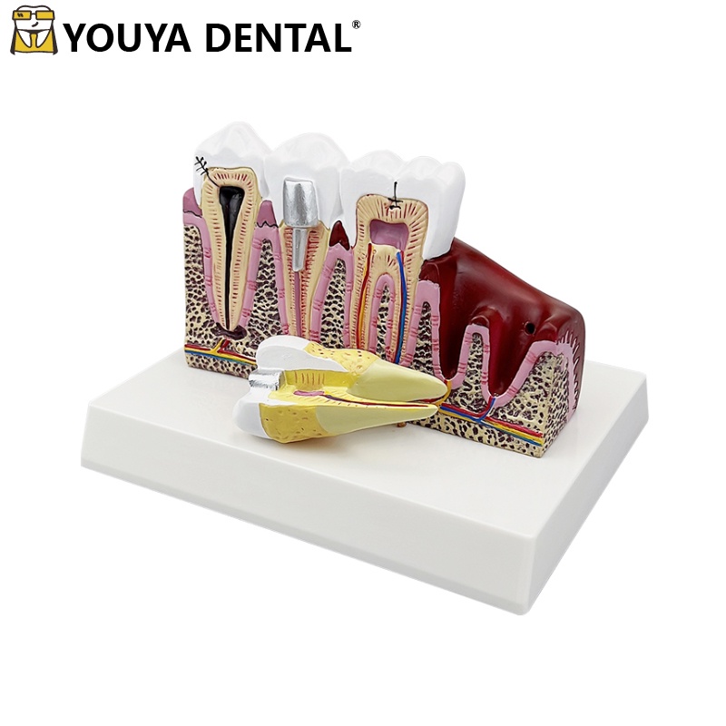 Suitable for School Dentistry Standard Oral Dental Anatomy Teaching ...