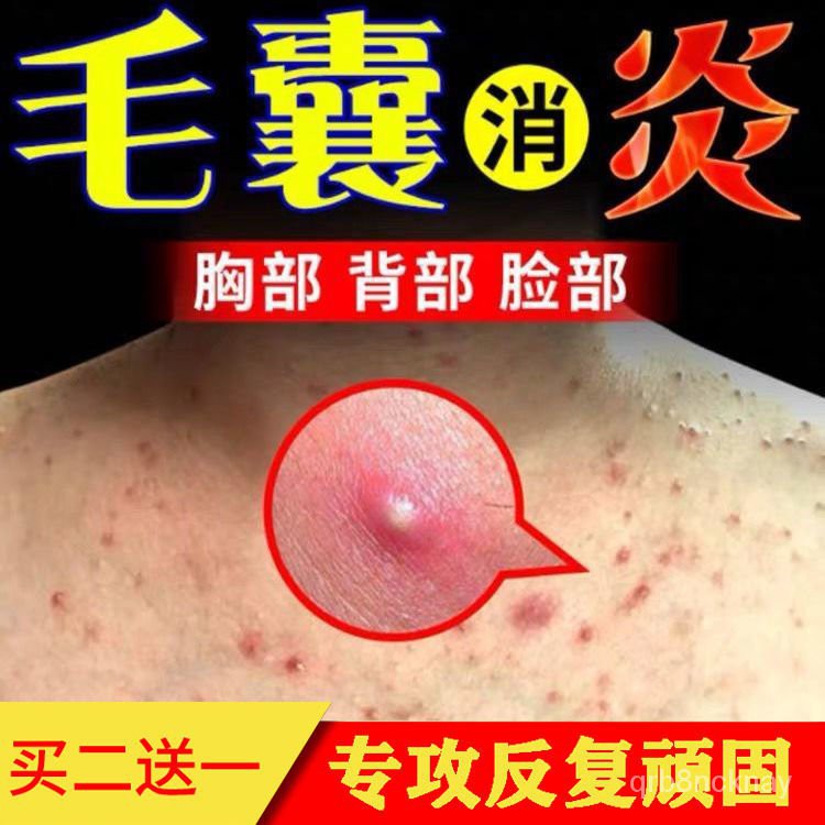 Treatment of Folliculitis Ointment Head Scalp Back Facial Abscess Bag ...