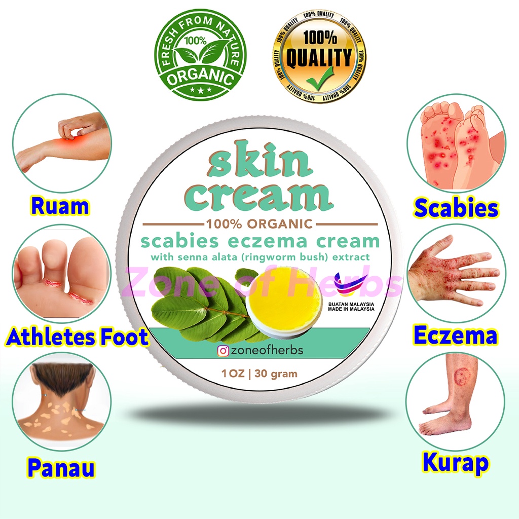 Krim Scabies Eczema dengan Ekstrak Daun Gelenggang untuk Panau Gatal ...