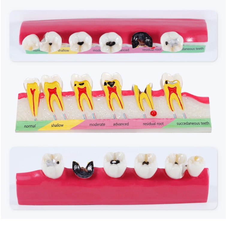 Dental Caries Classify Tooth Model Demonstration Teach Study Evolution ...