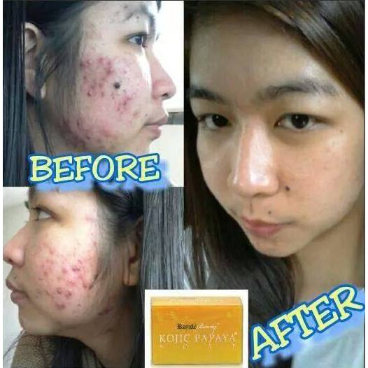 Royale Kojic Soap Before And After