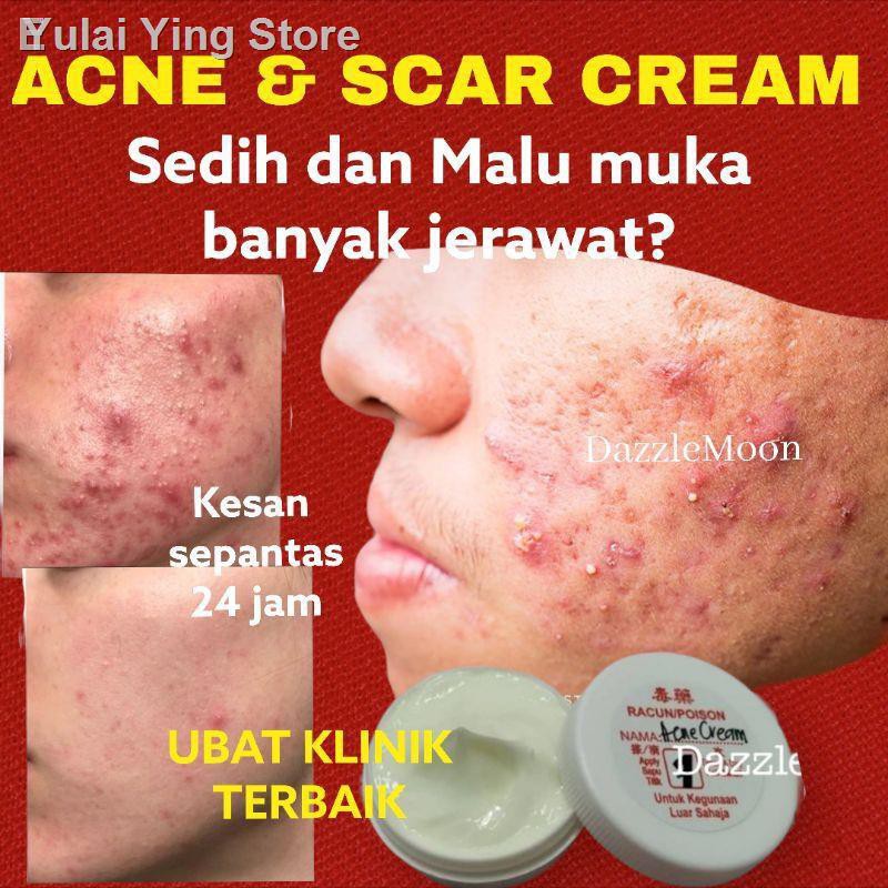 ﹍Acne Cream, Krim Jerawat ,Ubat Anti Fungul ,5g, UbatPustules, Papules ...
