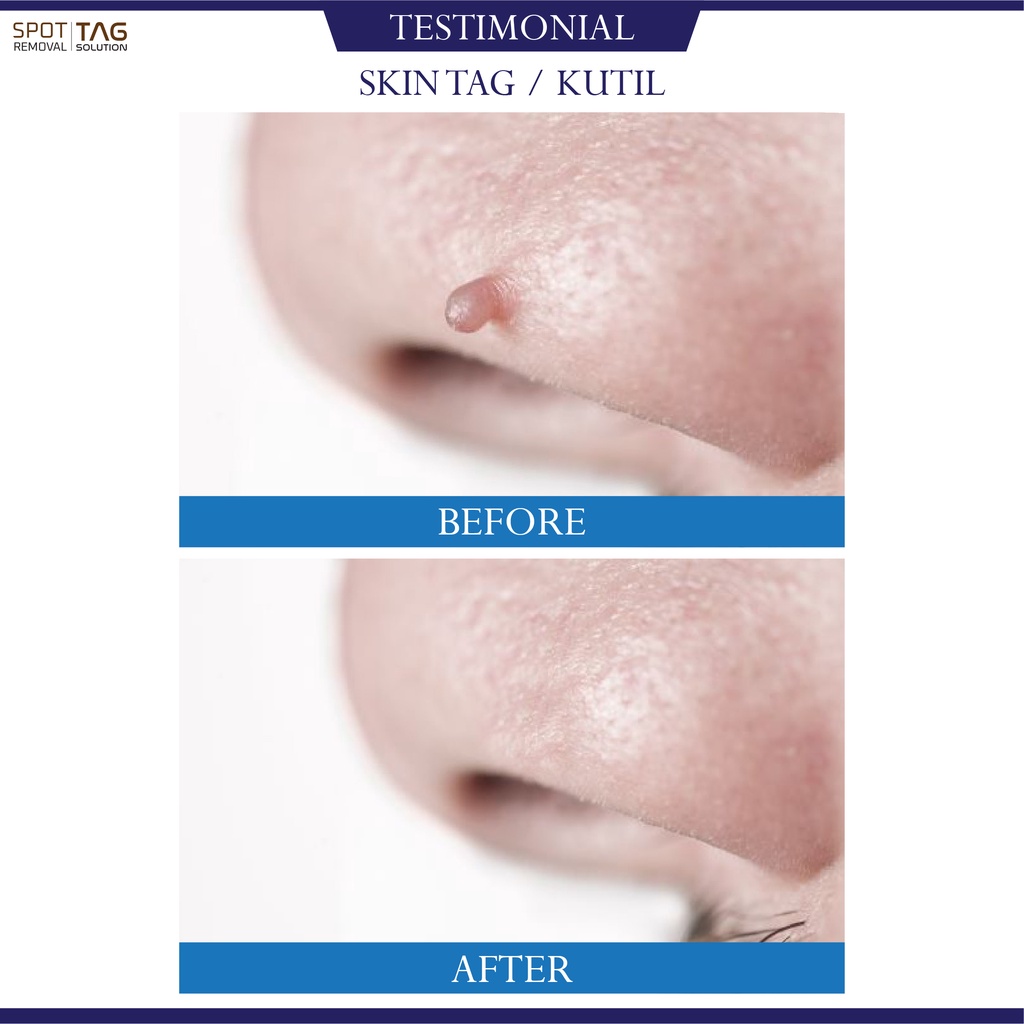 Skin Tag, Mole, Wart & Corn Removal 8ml - Buang Tahi Lalat, Ketuat ...