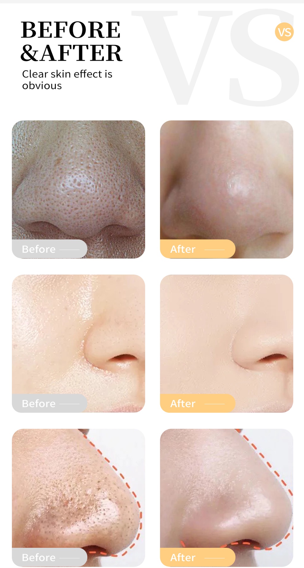 RtopR Gold Blackhead Removal Mask Treats Blackheads and Whiteheads Pore ...