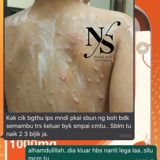 BEDAK GATAL semambu neem / kayap / kudis / panau / ruam / kayap air ...