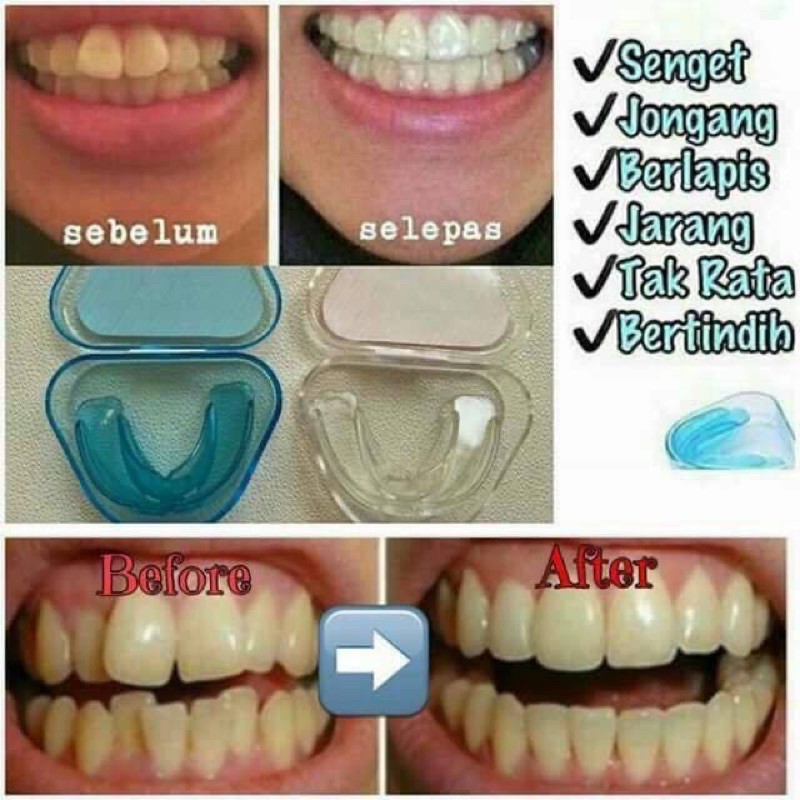 ORIGINAL TEETH TRAINER Jom Cantikkan gigi jonggang, senget, berlapis ...