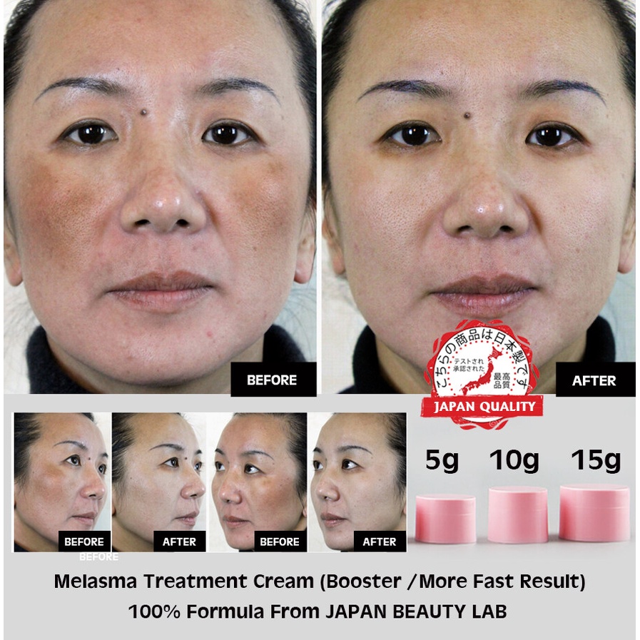 Melasma Treatment Cream (Booster)/ Jeragat Krim / 100% BERKESAN pakar ...