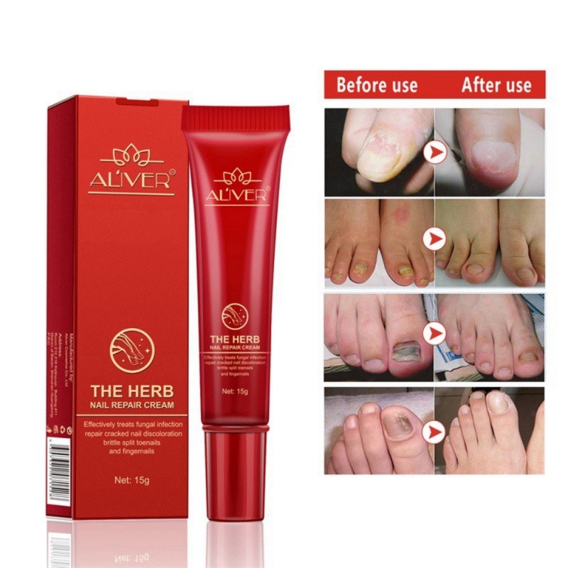 Toe Nail Fungus Treatment Cream Onychomycosis Paronychia Anti Fungal