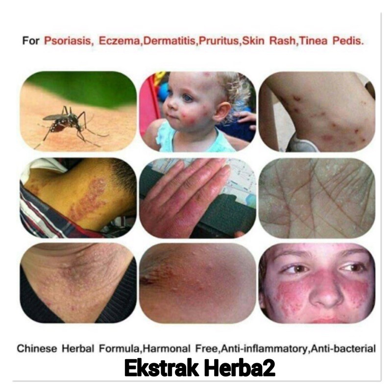 UBAT GATAL MUJARAB / ECZEMA TREATMENT CREAM / UBAT KURAP MUJARAB ...