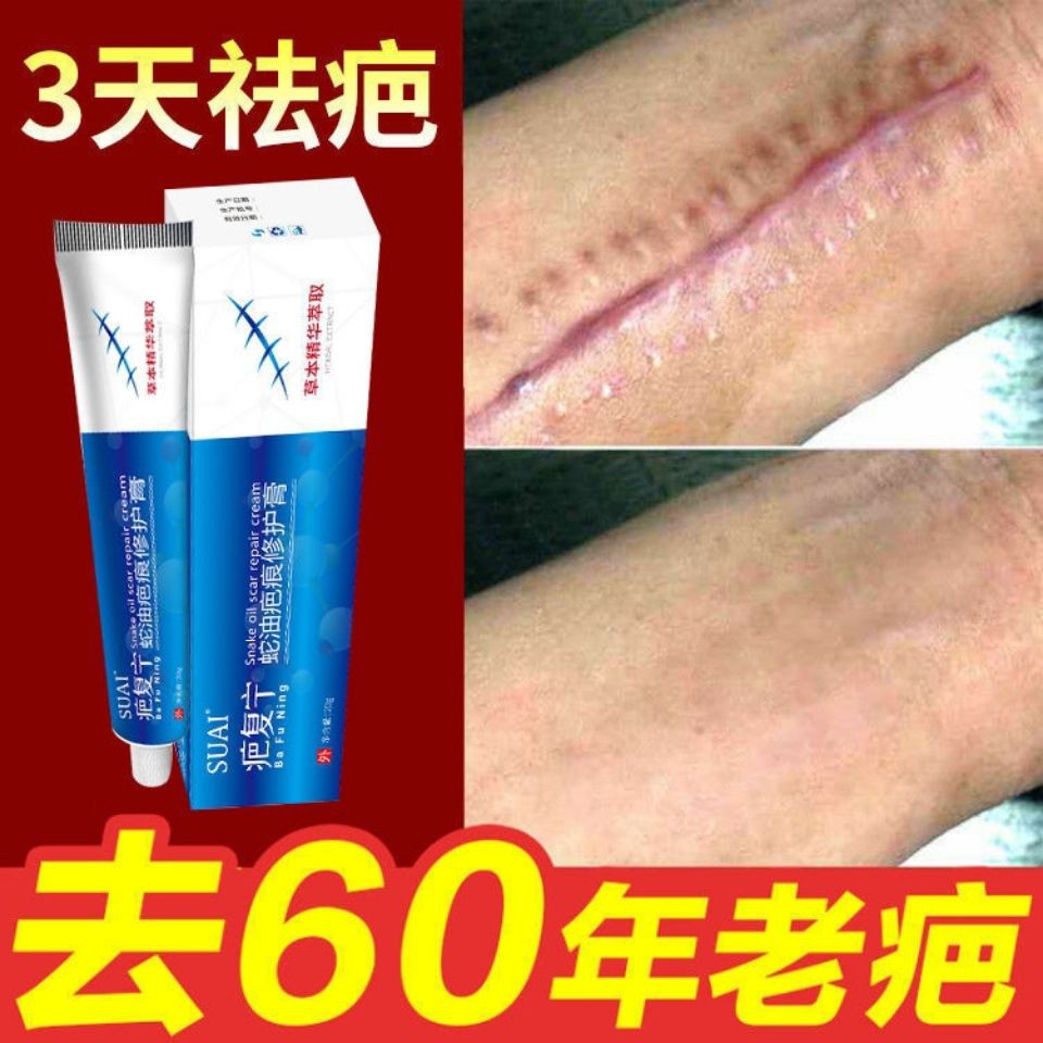 Scar removal cream, bumps, scalds, falls, scratches, scars, acne marks ...