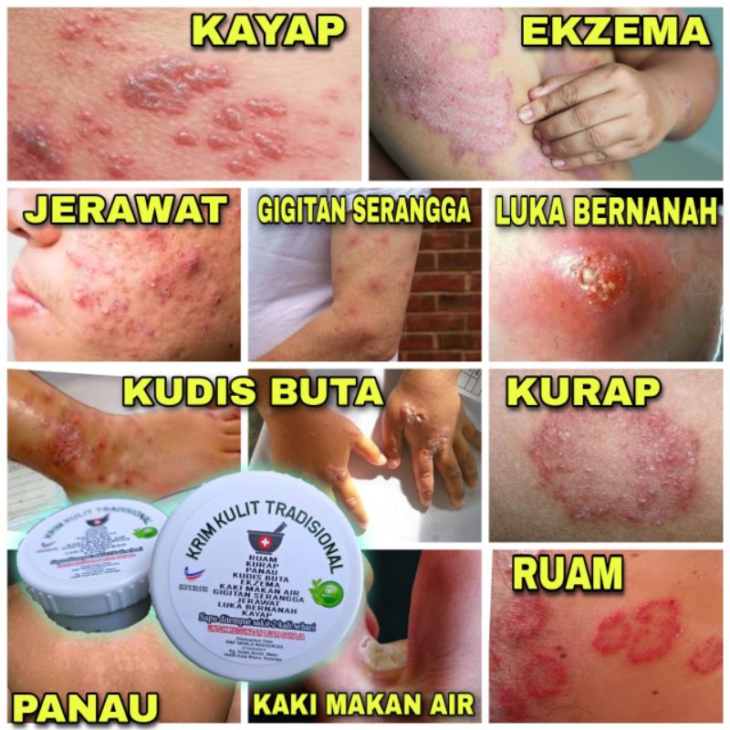 KRIM KULIT TRADISIONAL GATAL, KURAP, PANAU, KUDIS, RUAM, KAYAP, JERAWAT ...