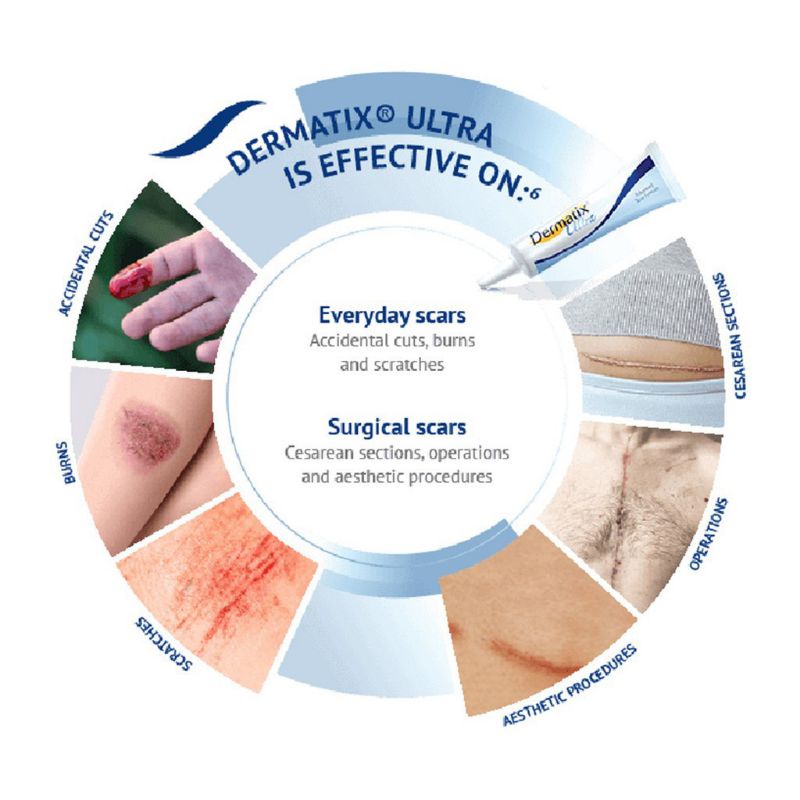 Dermatix Ultra gel 15g Advance Scar Formula Removal Repair Skin Care ...