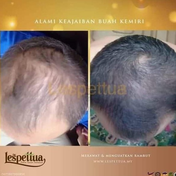 Pelebat Rambut Organik Lespettua, Online Shop | Shopee Malaysia