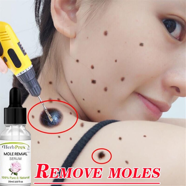 VE Facial mole remover freckles Essential oil Lightening Melanin Dark ...
