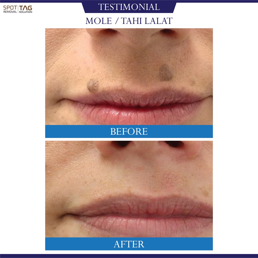 Skin Tag, Mole, Wart & Corn Removal 8ml - Buang Tahi Lalat, Ketuat ...