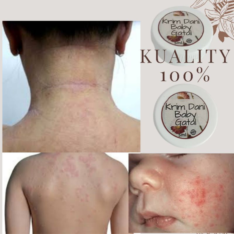 krim dani baby gatal/ruam lampin/exzema | Shopee Malaysia