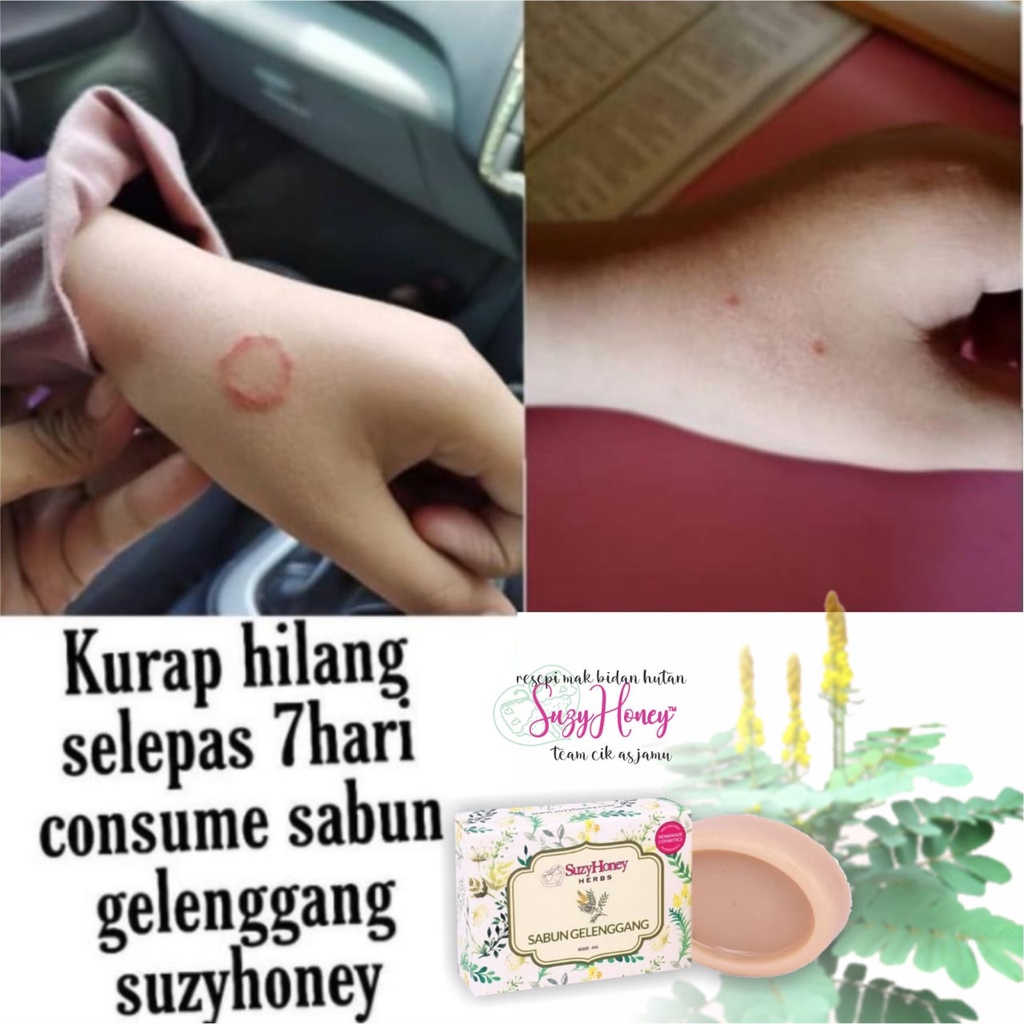 PANAU dgn SABUN GELENGGANG SUZYHONEY Hilangkan bau badan, ruam, panau ...