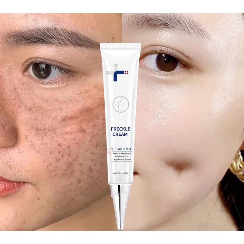 Freckles Cream/ Krim Jeragat Serius/ Pigmentation/ Whitening/ Blemishes ...