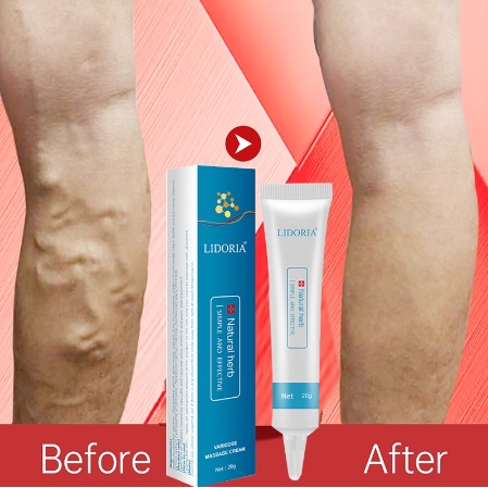 Leg Pain Relief Ointment Salap penjagaan vena varikos Melexu Salep ...