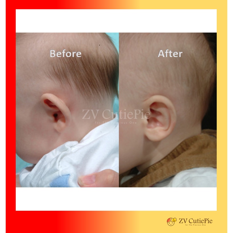 🔥Newborn Baby Neonatal Silicone Auricle Correction Patch Ear Molding ...