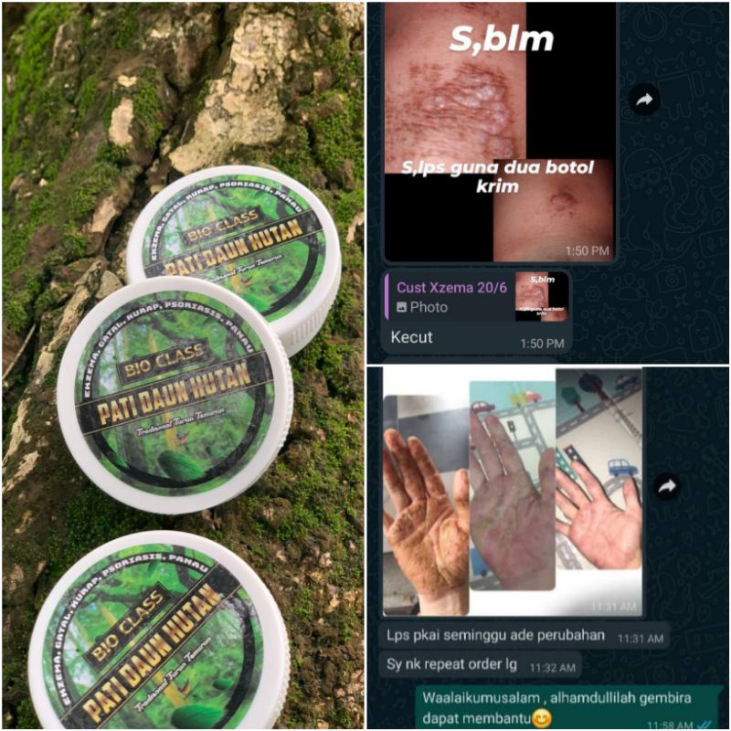 Krim X-Zema Daun Gelenggang Dari Pati Daun Hutan Untuk Merawat Sakit Kulit Ekzema, Kurap Dan ...