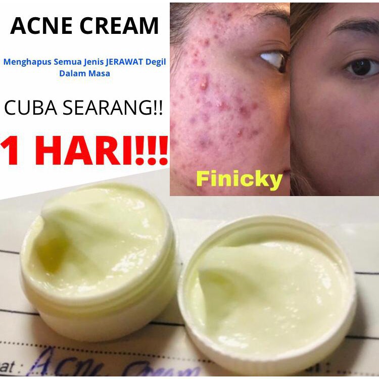 Acne Cream, Krim Jerawat, Ubat Jerawat Anti Fungal, Ubat Pustules ...