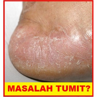 UBAT PSORIASIS BERKESAN UBAT KURAP KRIM KAKI BERKULAT UBAT TUMIT ...