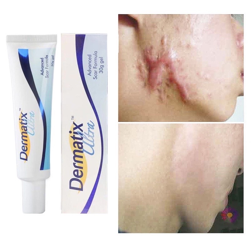 Dermatix Ultra Gel Dermatix Ultra Gel 15g, 5g / Dermatix Acne Scar 5g ...