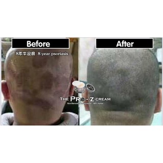 THE PROZ CREAM 300 GRAM -KRIM EKZEMA/ KURAP (99% HEALED ECZEMA ...