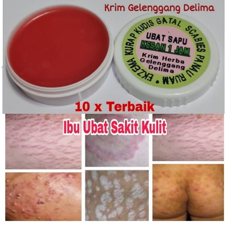 Cream Gatal kesan ganda Gelenggang Delima untuk kulit gatal kurap kudis ...