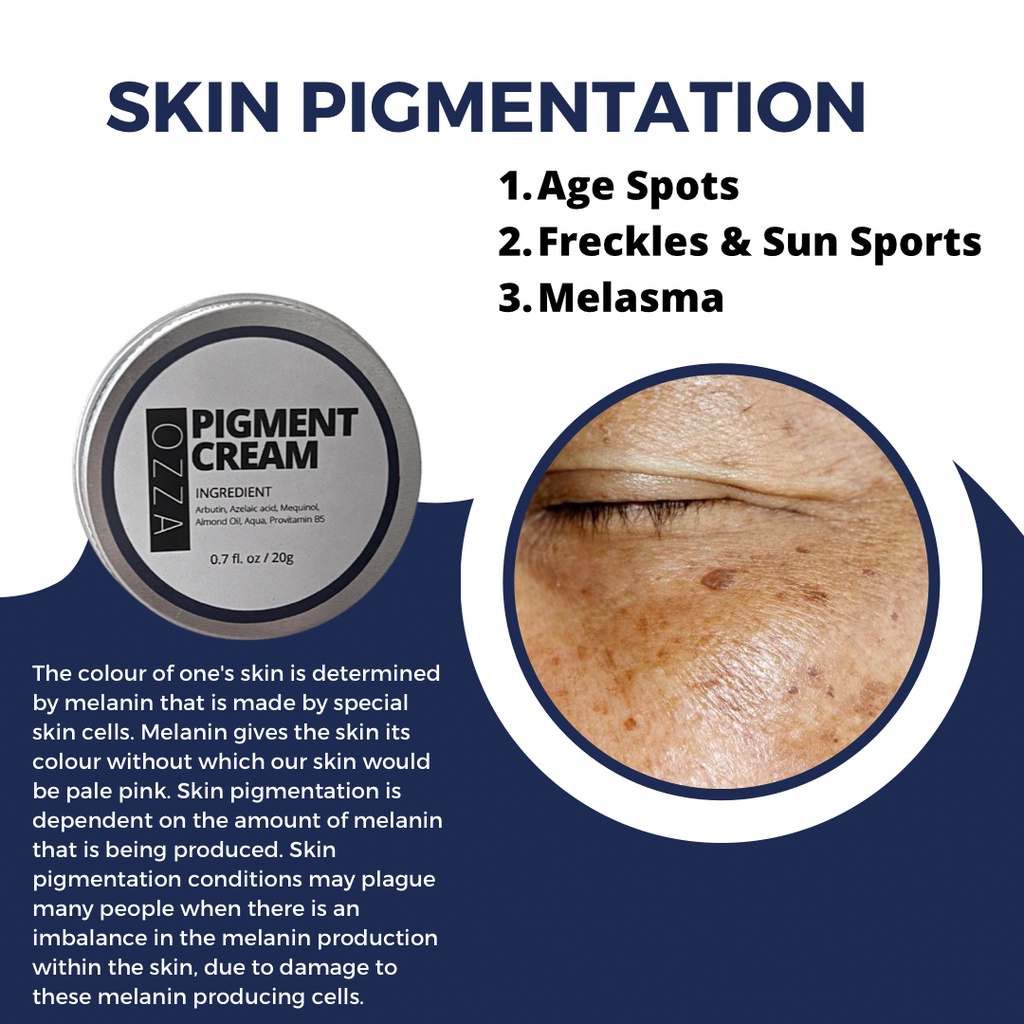 Pigment Cream Kulit Kusam Tompok Hitam Melasma Jeragat | Shopee Malaysia