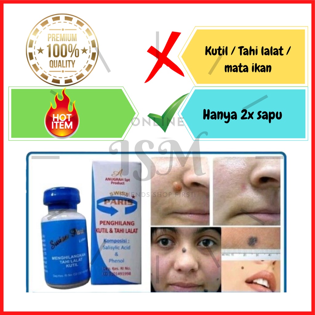 Ubat Ketuat Skin Tag Wart Mole Remover Buang Tahi Lalat Kutil Biji ...