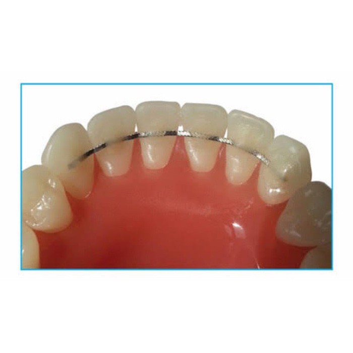 Fixed Orthodontic Retainer