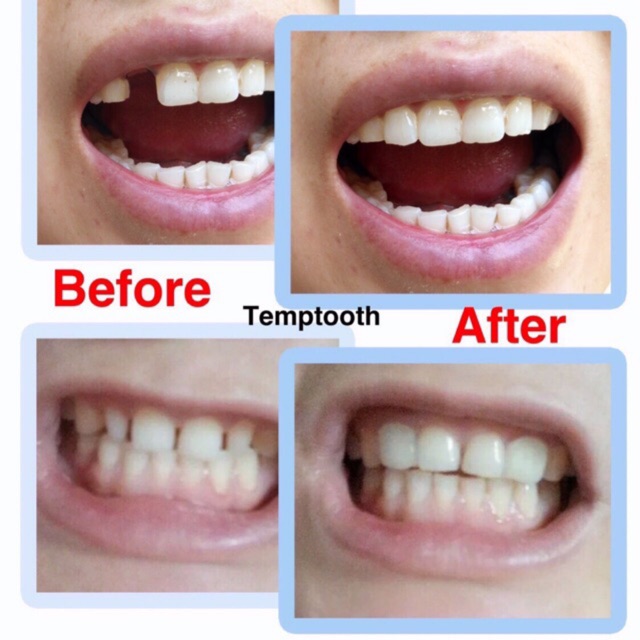 GIGI PALSU TEMPTOOTH khas untuk gigi hilang sebatang selang sebatang ...