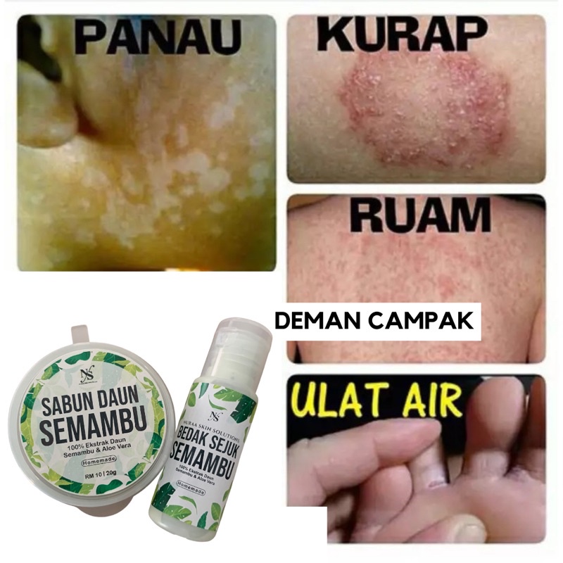 BEDAK GATAL semambu neem / kayap / kudis / panau / ruam / kayap air ...