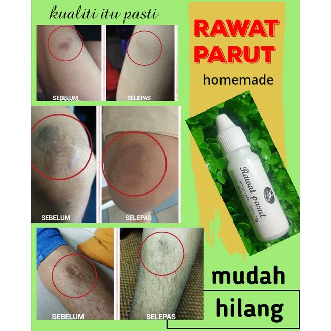 krim rawat parut,menghilangkan parut,parut lama dan parut baru,bintik ...