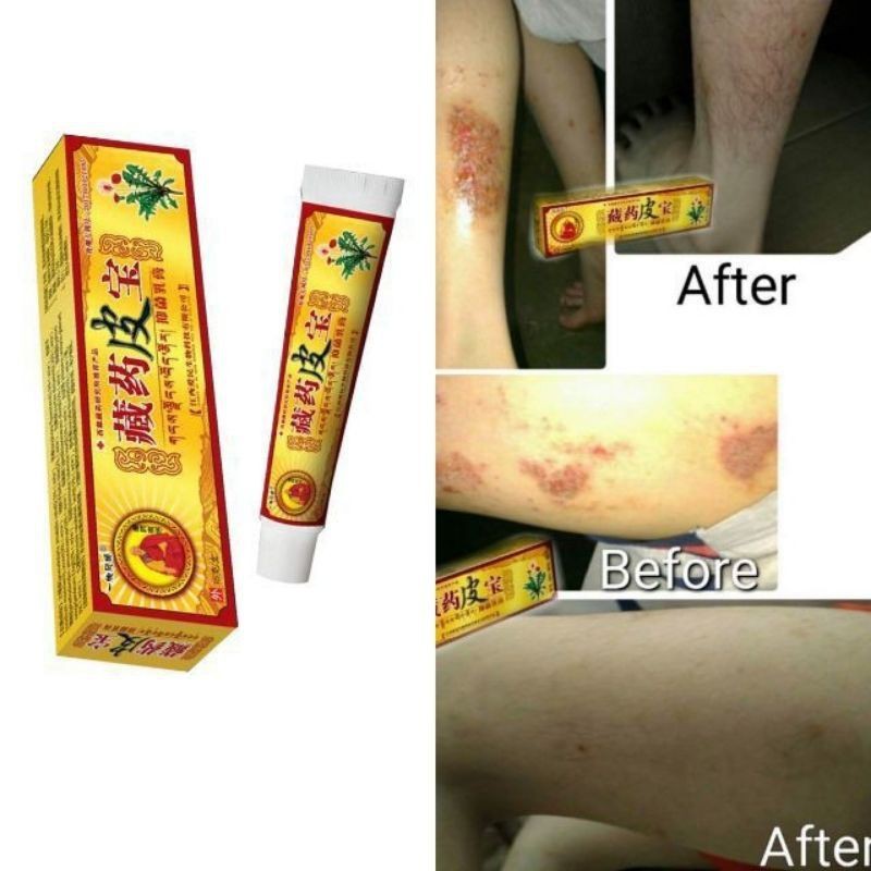 Herbal cream for eczema,water fungus,boils,itching,psoriasis,eounds ...