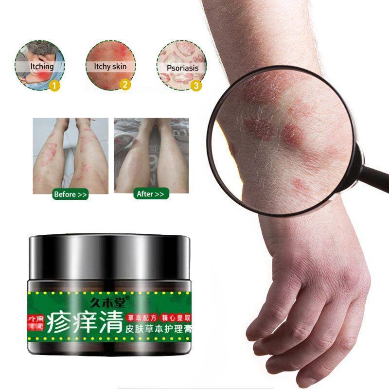 Rash itching clearing rash herbal antibacterial cream skin itching ...