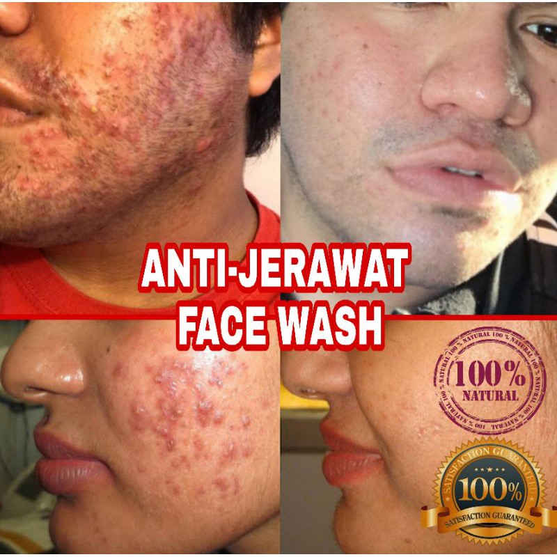 PENCUCI MUKA KLINIKAL - SANGAT BERKESAN PENCUCI MUKA ANTI JERAWAT/ANTI ...