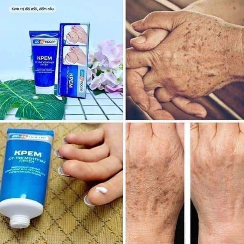 KPEM Age Spots Dark Spots Brown Spots Hand Skin Care Cream | Shopee ...