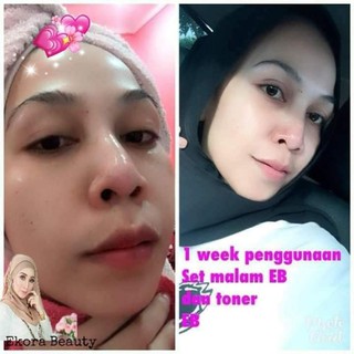 VIP SET SKINCARE EKORA BEAUTY | Shopee Malaysia
