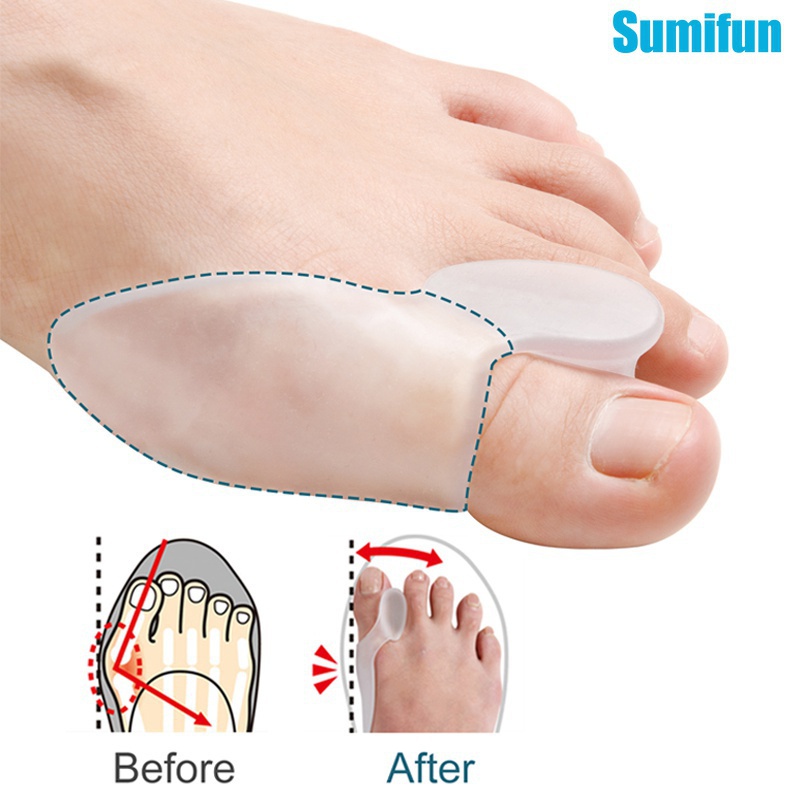 Hallux valgus corrector silicone big toe separator overlapping thumb ...