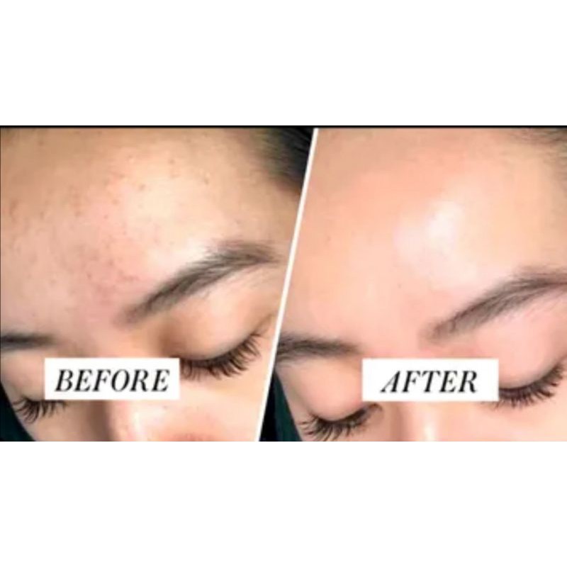 Cerave Retinol Serum For Post Acne Marks And Skin Texture Pore Refining