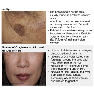 Pigment Cream Kulit Kusam Tompok Hitam Melasma Jeragat | Shopee Malaysia