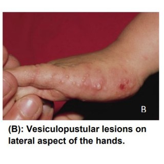 Ascabs Anti-Scabies Lotion 30ml (Losyen Kutu Kepala dan Kudis Buta ...