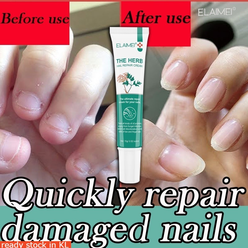 CL 100% Herbal Nail Repair Cream Anti Fungal Nail Infection ...