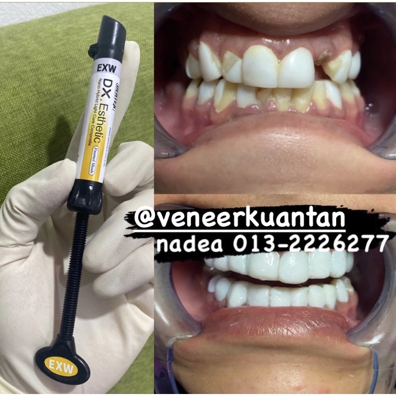 dentex composite veneer 4g | Shopee Malaysia