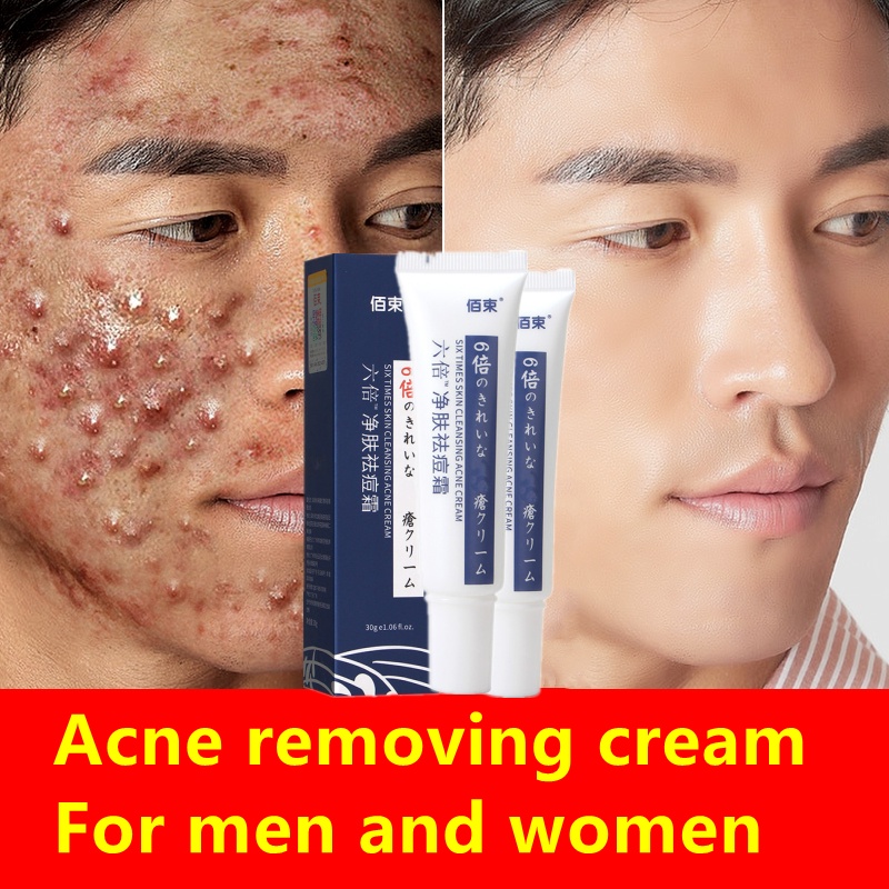 Repair acne removing cream anti pimples acne marks acne pits fade ...