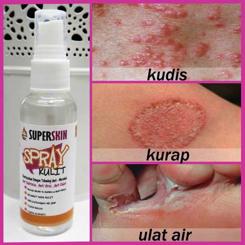 Ubat Kurap 🔥 Gatal Kayap Ruam Ekzema Kudis Psoriasis Scabies Itchy ...
