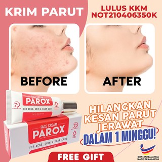 [READY STOCK] Cream Parox Krim Parut Krim Deep Scar Cream / Parut ...